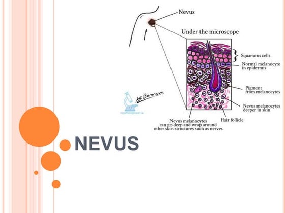 Compound Nevus Histopathology Compound Melanocytic Nevus