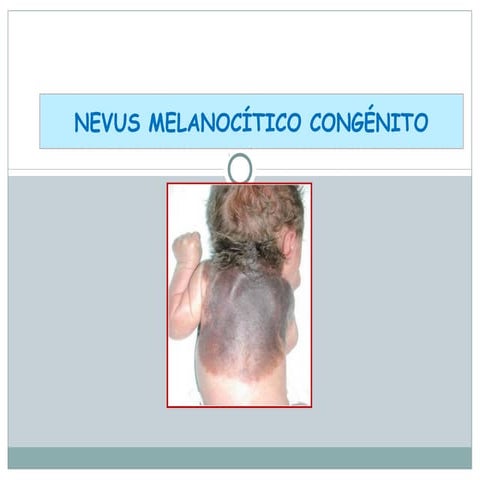 Nevus melanocitico congenito, diagnostico y tratamiento | PPT