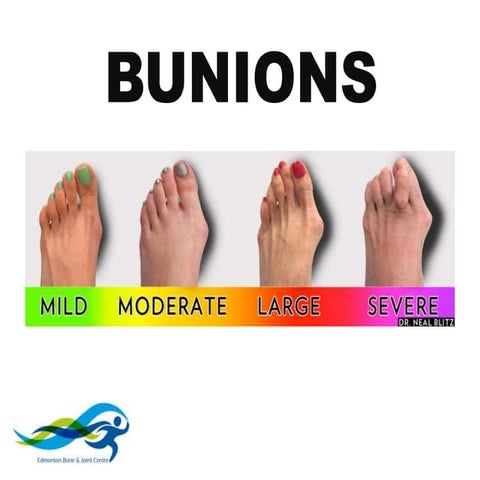 Edmonton Bone and Joint Centre Bunion Presentation v2 | PPTX