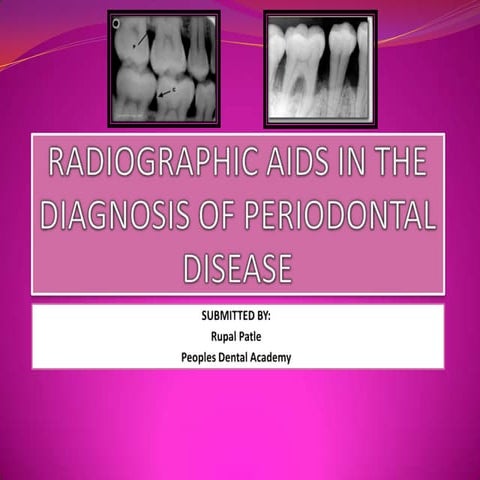 RADIOGRAPHIC AIDS IN THE DIAGNOSIS OF PERIODONTAL DISEASE | PPTX