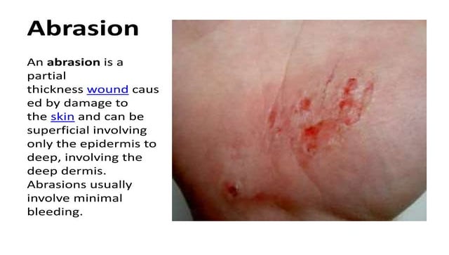 Abrasion Definition