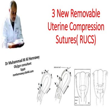 3 New removable uterine compression sutures | PPT