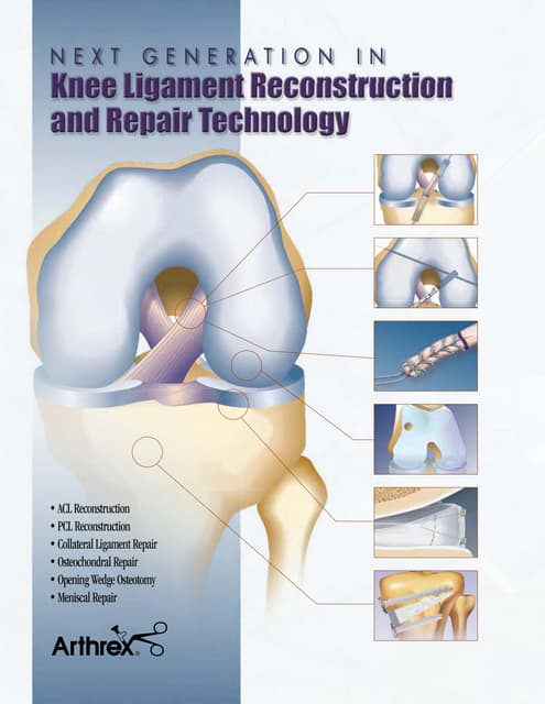 Lt0515 d suturebridge | PDF