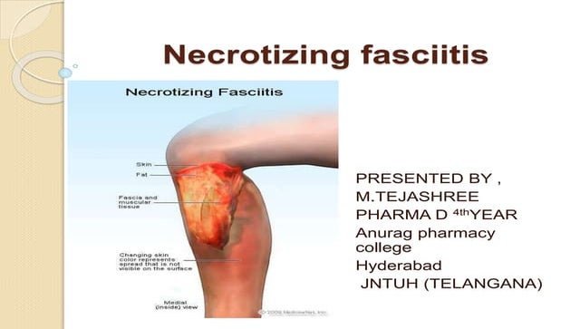 Necrotizing Fasciitis Diagram