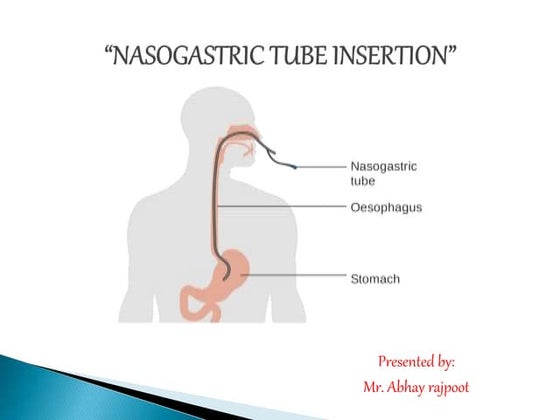 Nasogastric tube insertion | PPT
