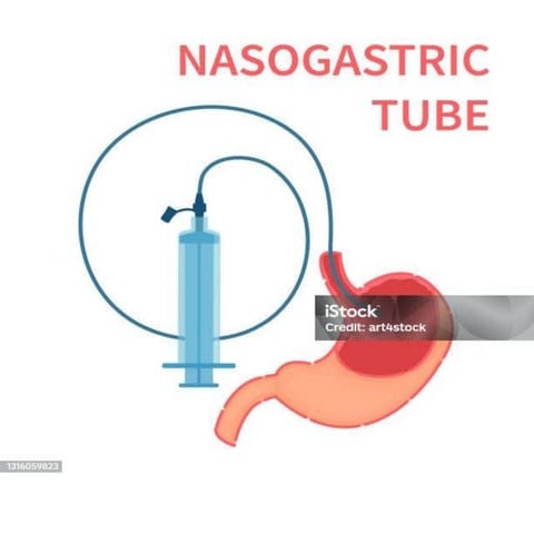 NG Tube Feeding.pptxRYLES TUBE FFEDING PROCEDURE | PPTX
