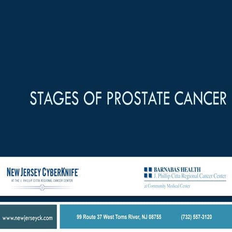 Stages of Prostate Cancer | PDF | Cancer | Diseases and Conditions