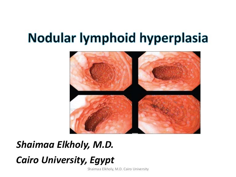 Diffuse Nodular Lymphoid Hyperplasia (DNLH)