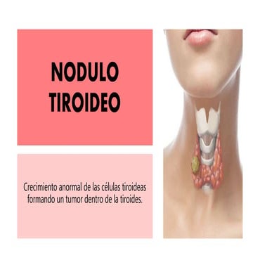 Nodulo tiroideo | PPTX