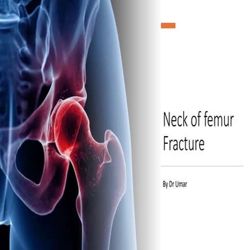 Neck of femur fracture. Power point presentation | PPTX