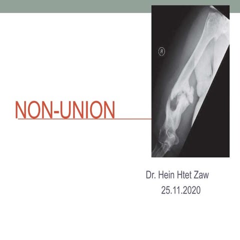 Delayed Union and non union fractures | PPTX