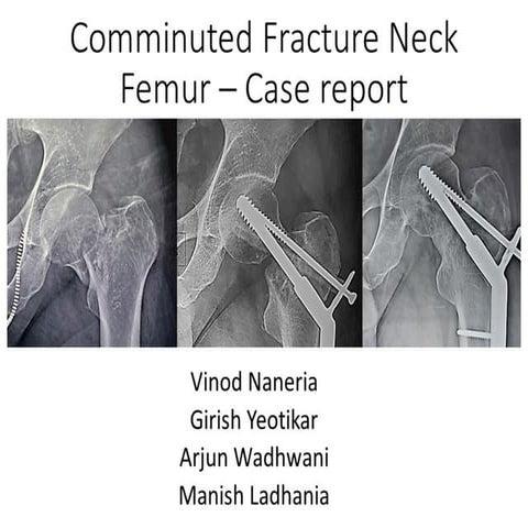 Non-Union of Fracture Neck of Femur.pptx