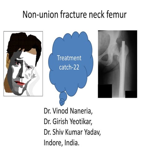 Non union fracture neck of femur | PDF