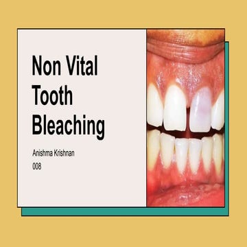 Non Vital Tooth Bleaching .pptx- conservative and endodontics | PPTX