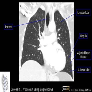 Normal Anatomy on Chest Radiograph 20-21.pdf