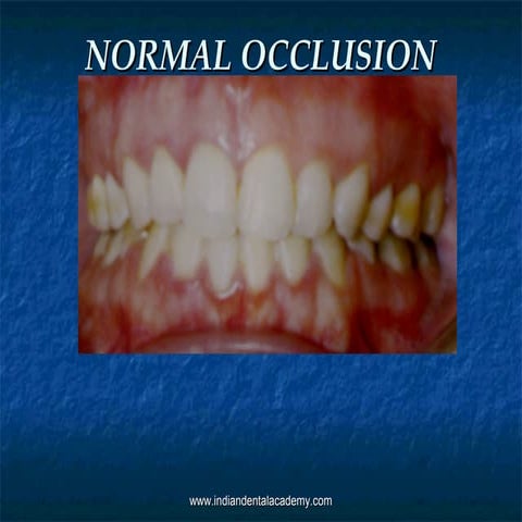 Normal occlusion (2) | PPT | Dental Health | Diseases and Conditions