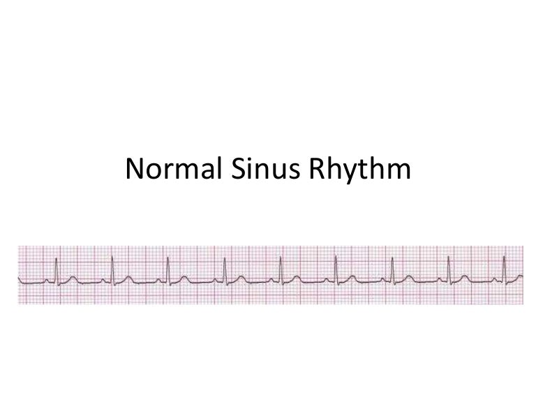 Normal sinus rhythm