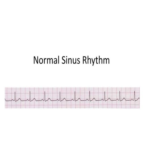 Normal sinus rhythm | PPTX