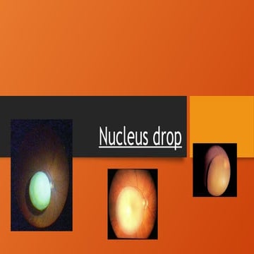 Complications of cataract surgery - nucleus drop | PPTX