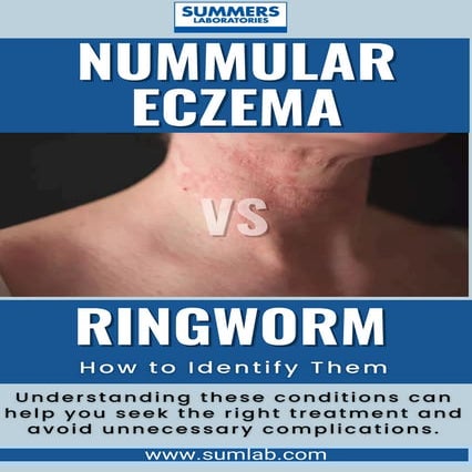 What are the main differences between Nummular Eczema and Ringworm? | PDF