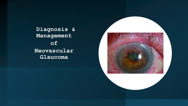 Neovascular Glaucoma ophthalmology medicine | PPTX