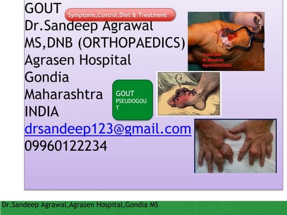 Gout case presentation | PPT