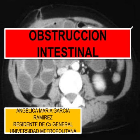 Obstruccion intestinal | PPTX