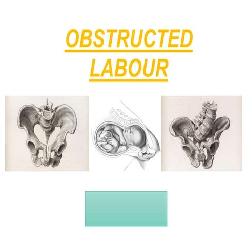 obstructedlabour-190807186377371745.pptx