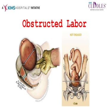 Obstructed Labour - a detailed study and review | PDF