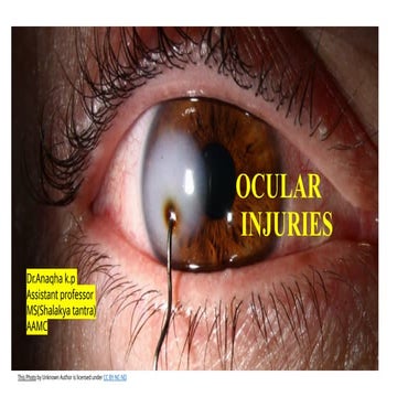 OCCULAR INJURIES ,TYPES AND ITS MANAGEMENT | PPT
