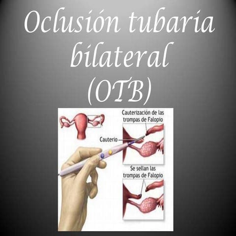 Oclusión tubaria bilateral | PPT