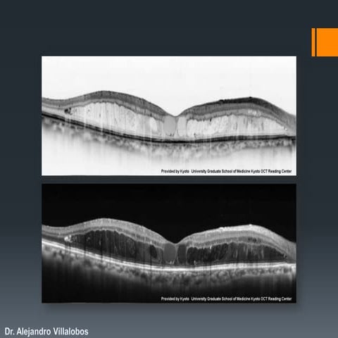 Oct for daily screening & diagnosis | PPTX | Eye and Vision Conditions ...
