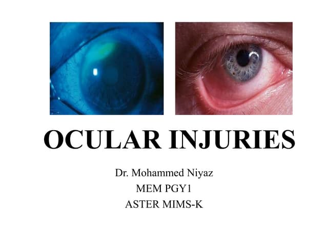 Presentation - Ocular Trauma.- injury to eye | PPTX