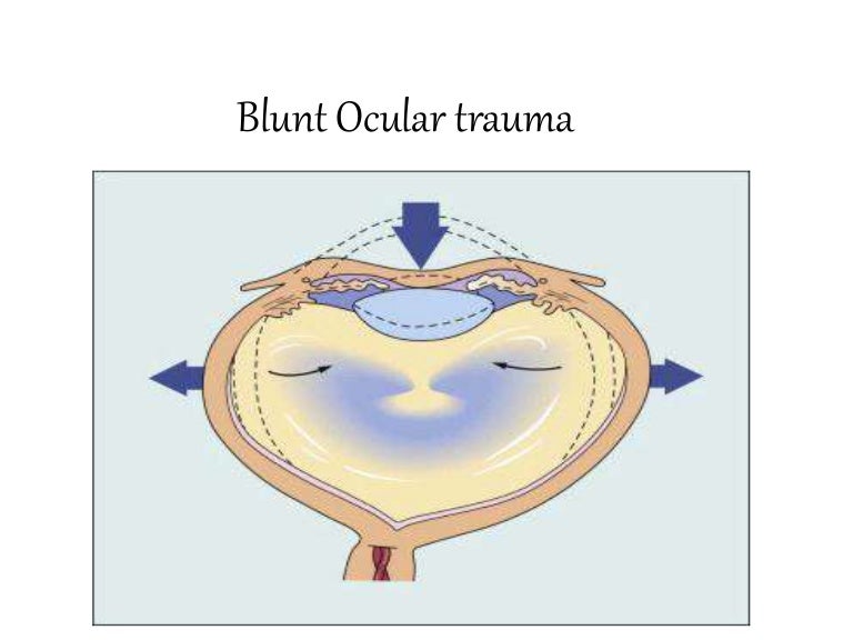 Blunt Ocular trauma