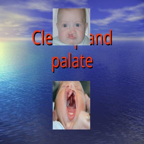 CLEFT LIP AND PALATE IN OMFS ADVANCED PPT | PPT