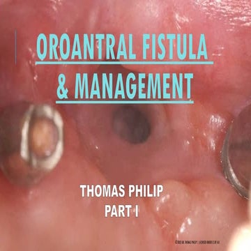 Oroantral Fistula and Management in Oral & Maxillofacial Surgery.pptx