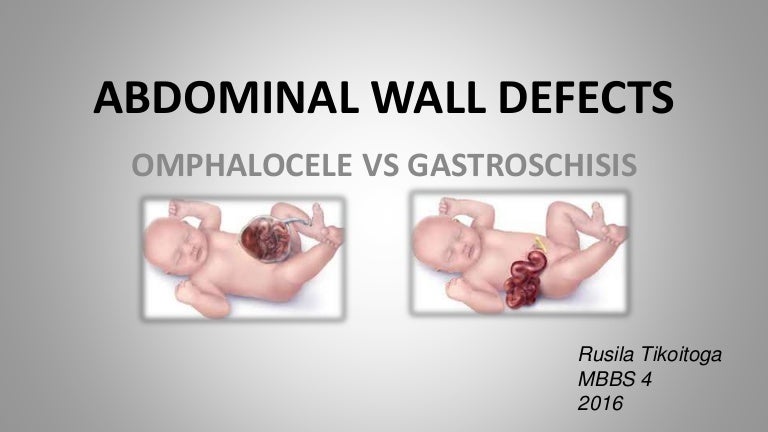 Omphalocele vs gastroschisis