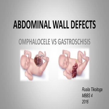 Omphalocele vs gastroschisis | PPTX