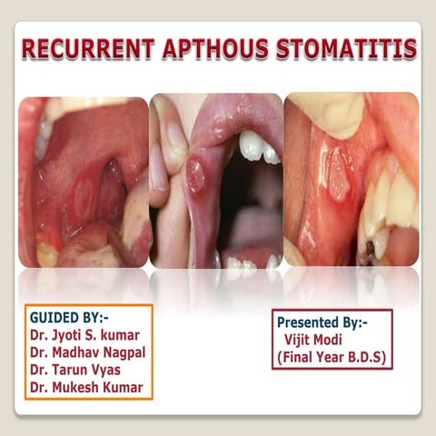 recurrent apthous ulcer | PPT