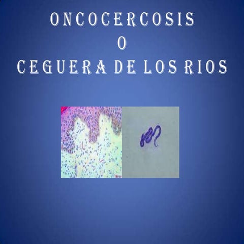 Oncocercosis | PPTX