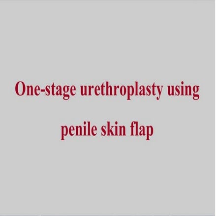One stage urethroplasty of penile urethra using penile skin flap | PDF