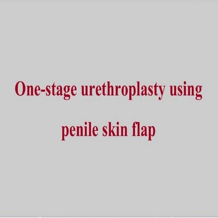 One stage urethroplasty using skin flap | PPT