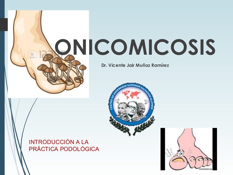 Onicomicosis, tipos, agentes infecciosos, tratamientos.