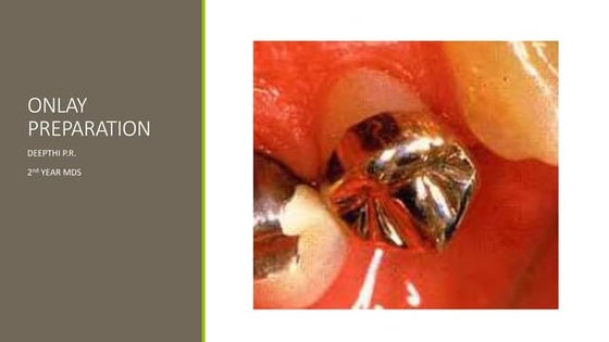 Inlays and Onlays | PPT