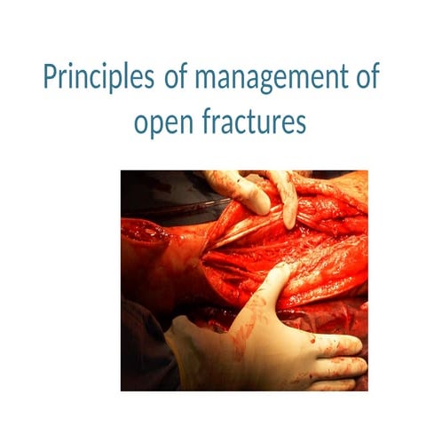 Open Fracture management 2-.........1.pptx