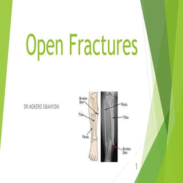 OPEN FRACTURES.pptx