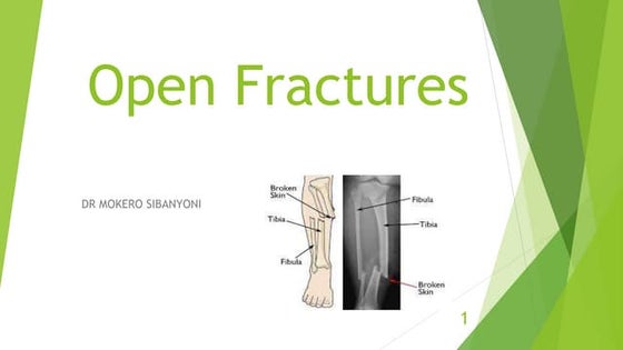 Open Fracture Diagram Comparison Of Mortality Between Open And Closed