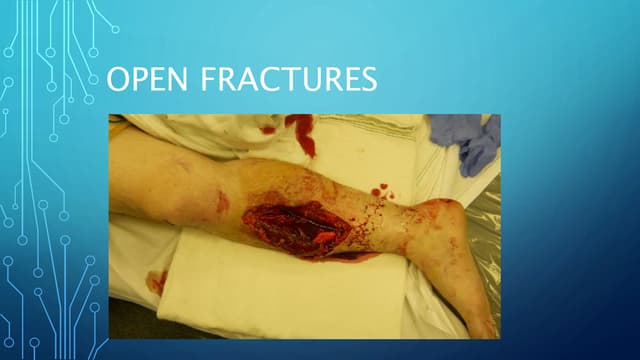 Open Fracture | PPTX