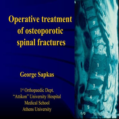 Operative treatment of osteoporotic spinal fractures | PPT