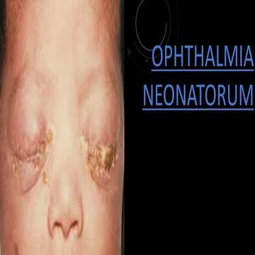 Ophthalmia Neonatorum or Neonatal Conjunctivitis